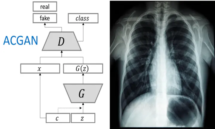 Auxiliary Classifier GAN for Covid & healthy X-rays image generation ...